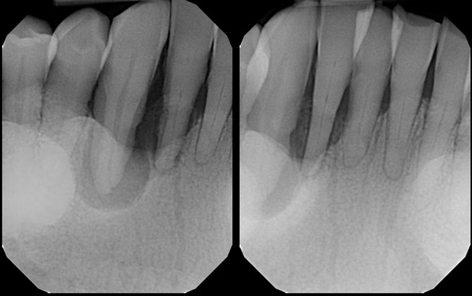 An in-office-fabricated implant surgical guide corrected using CBCT